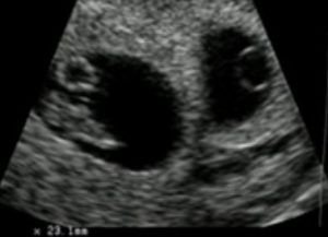 Síndrome de gemelo evanescente - Dra de la Calle | María de la Calle