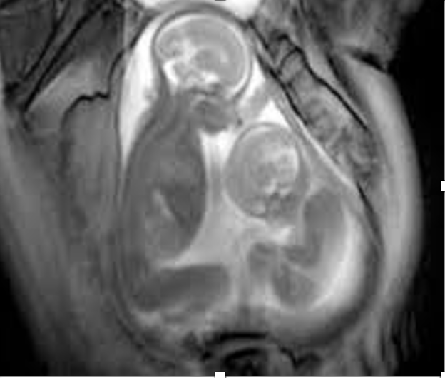 Gestación gemelar bicorial bimaniótica con un feto muerto - Dra de la ...